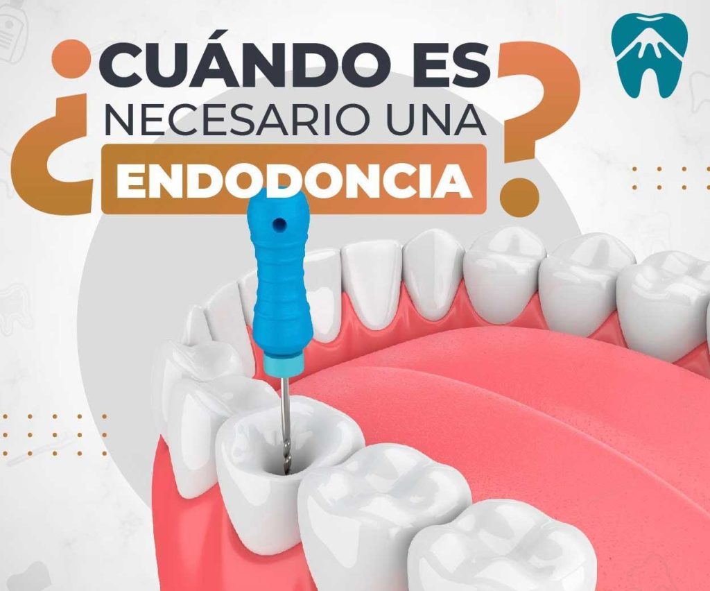 Endodoncia en Arequipa, Tratamiento sin Dolor – Dentista 🦷 Arequipa